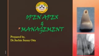 Open apex & its Management | PDF