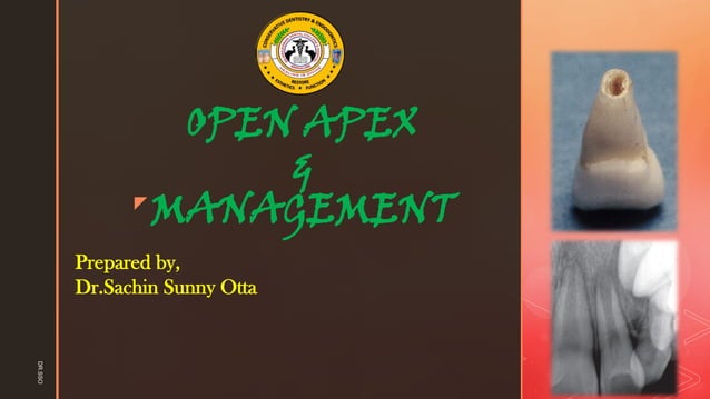 Open apex & its Management | PDF | Dental Health | Diseases and Conditions