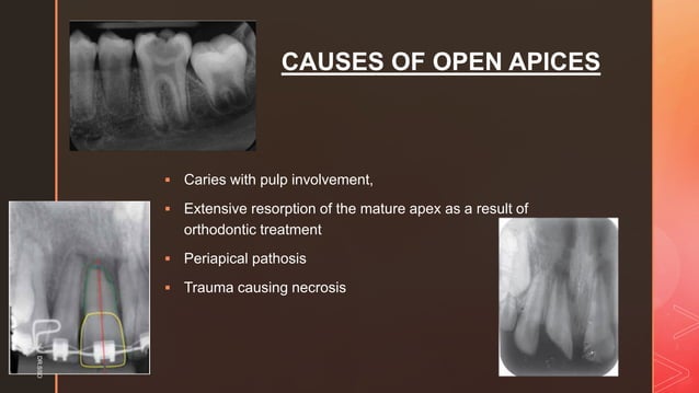 Open apex & its Management | PDF | Dental Health | Diseases and Conditions