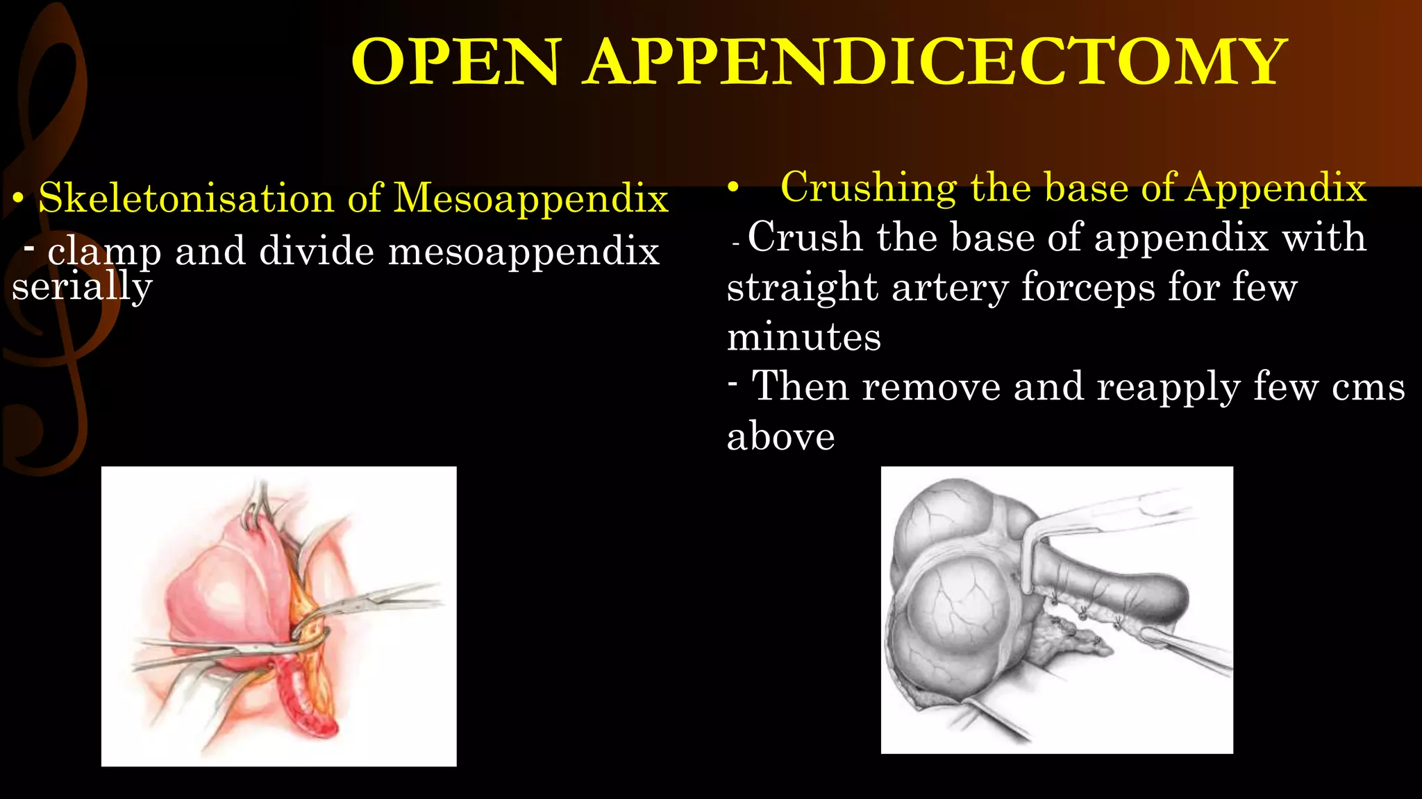 Open Appendicectomy operative surgery | PPTX