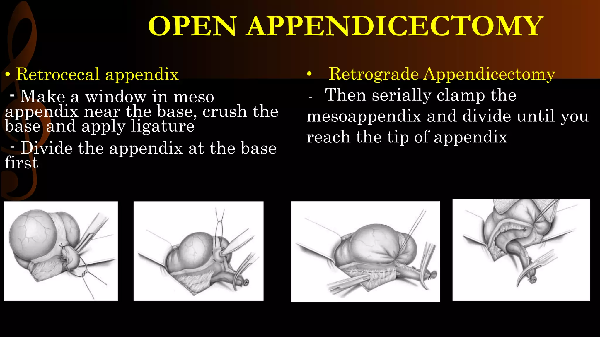 Open Appendicectomy operative surgery | PPTX