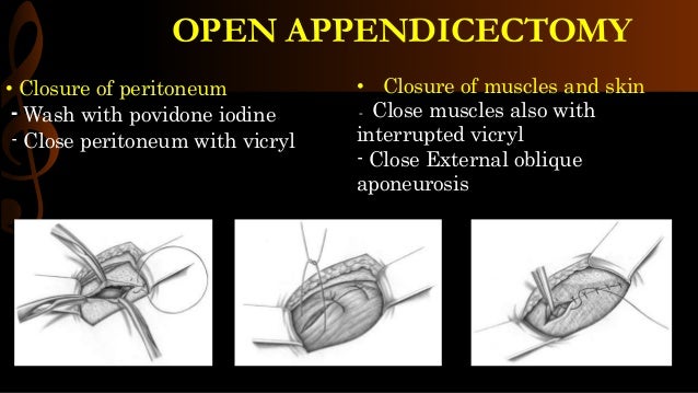 Open Appendicectomy operative surgery