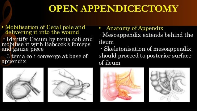 Open Appendicectomy operative surgery