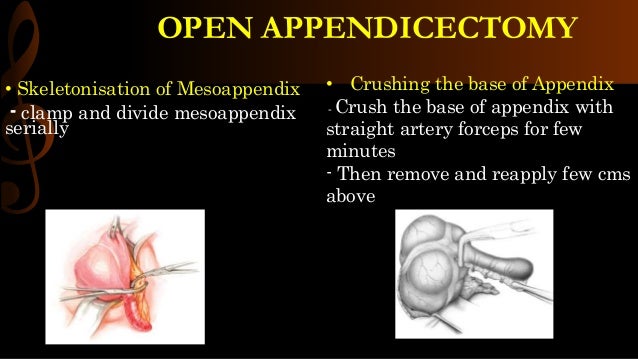 Open Appendicectomy operative surgery