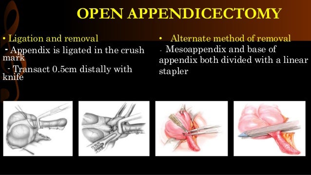 Open Appendicectomy operative surgery