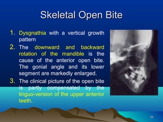 Bio mechanical considerations of Open bite. Dr. Ajay | PPT