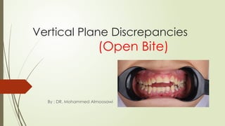 OPEN BITE THE ETIOLOGY AND MANAGEMENT .pptx