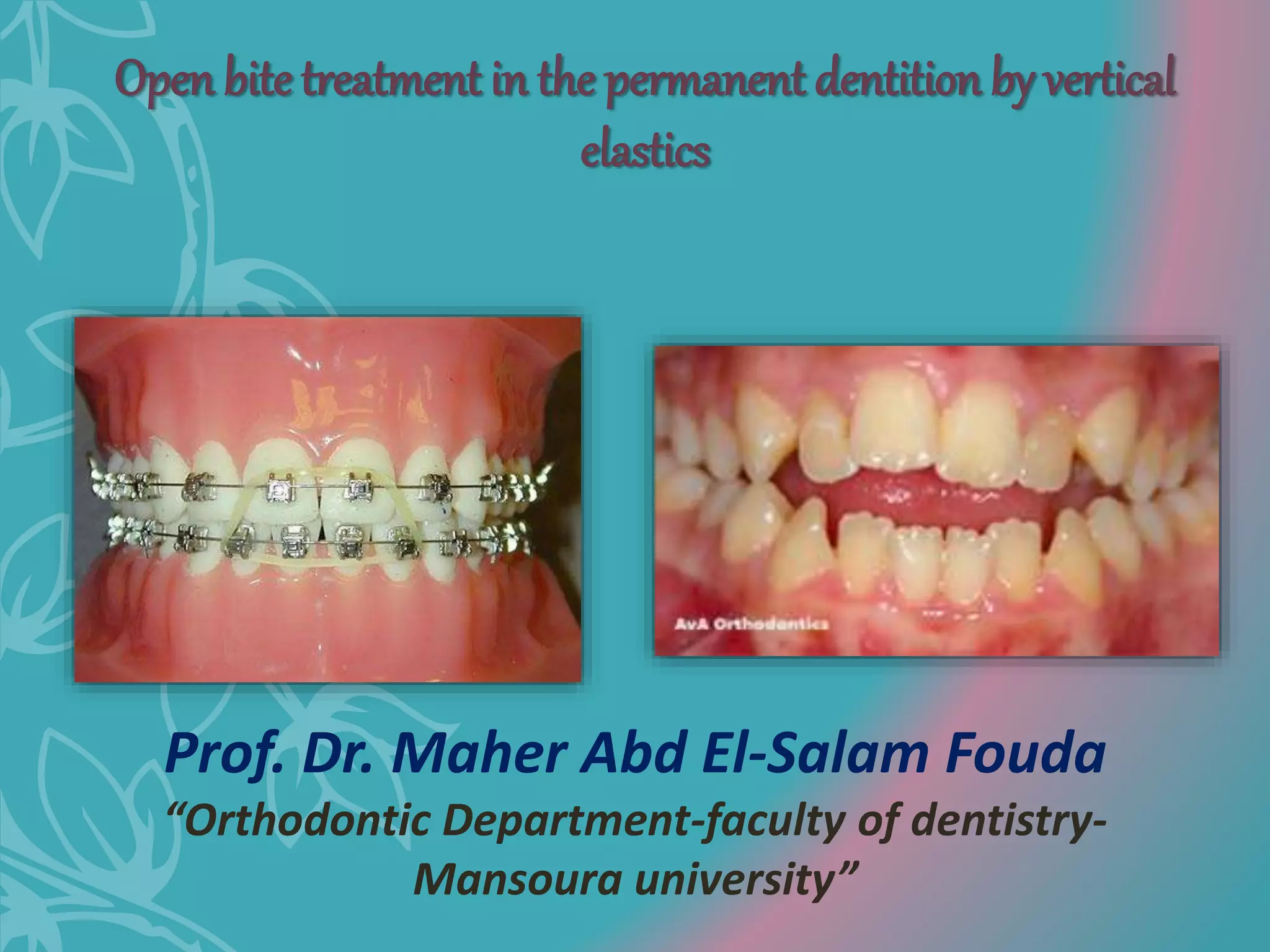 Open bite by Dr. Maher Fouda | PPTX