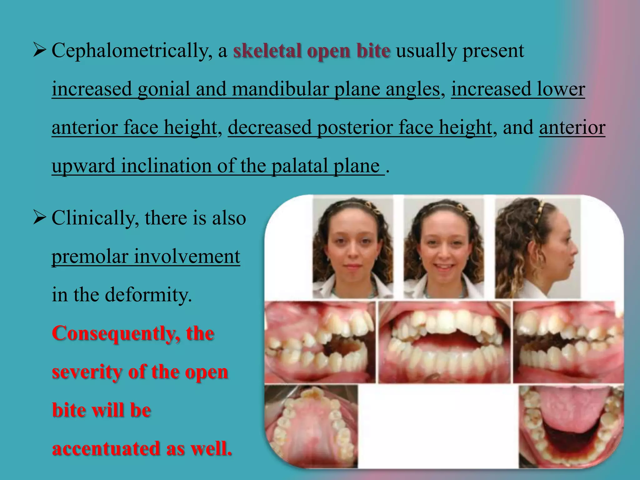 Open bite by Dr. Maher Fouda | PPTX
