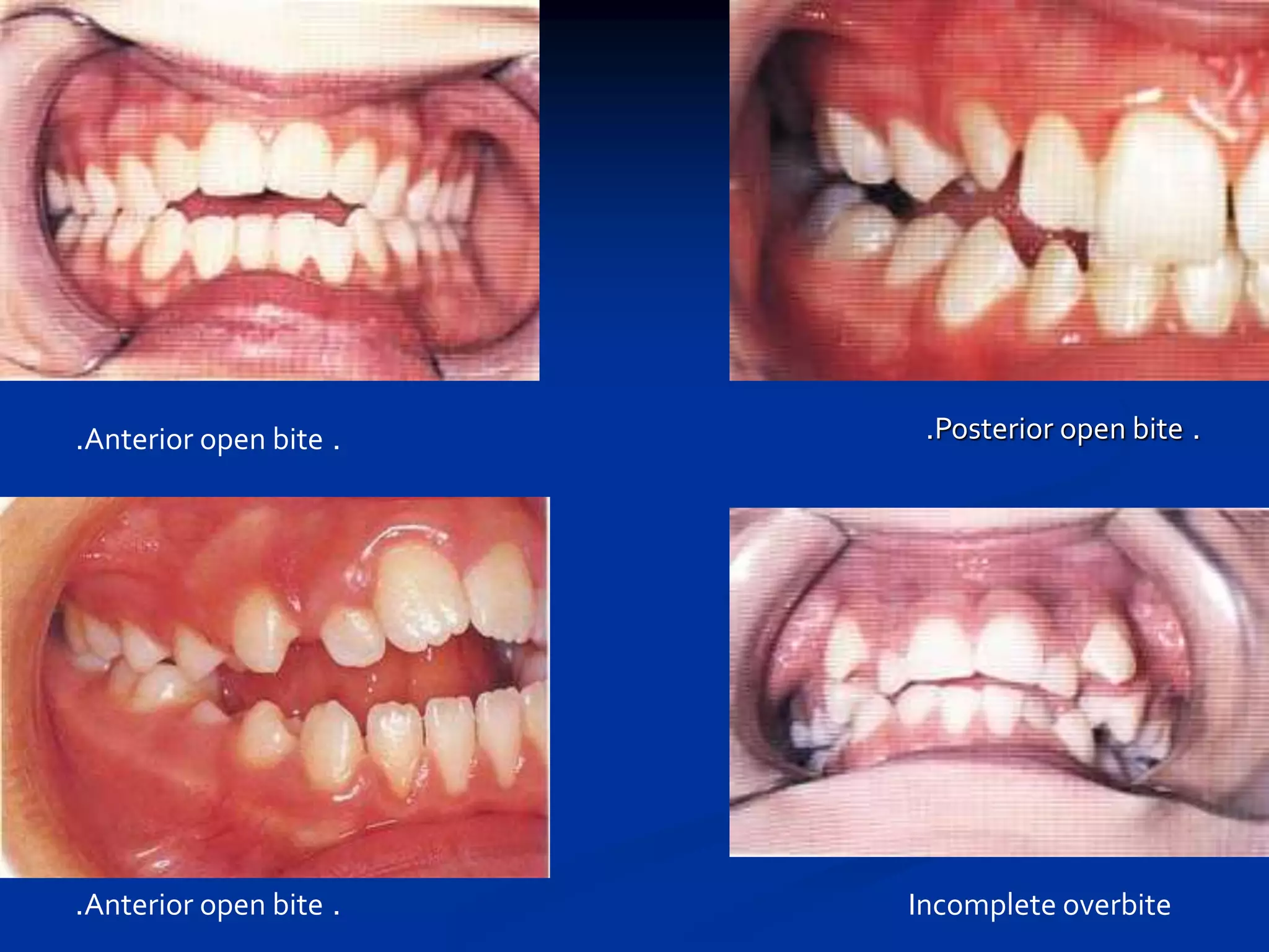 Open bite | PPT