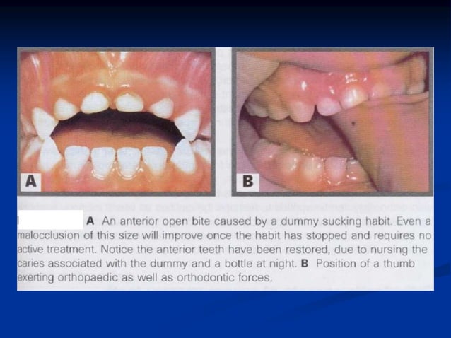 Open bite | PPT | Oral care | Personal Care