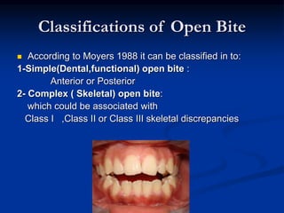 Open bite | PPT