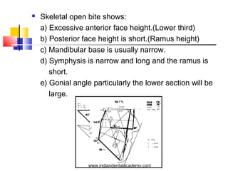 Open bite 1 /certified fixed orthodontic courses by Indian dental ...