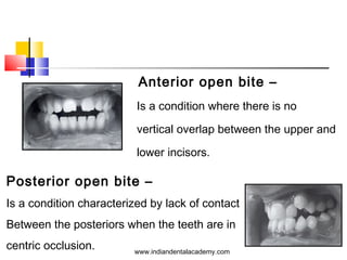 Open bite 1 /certified fixed orthodontic courses by Indian dental ...