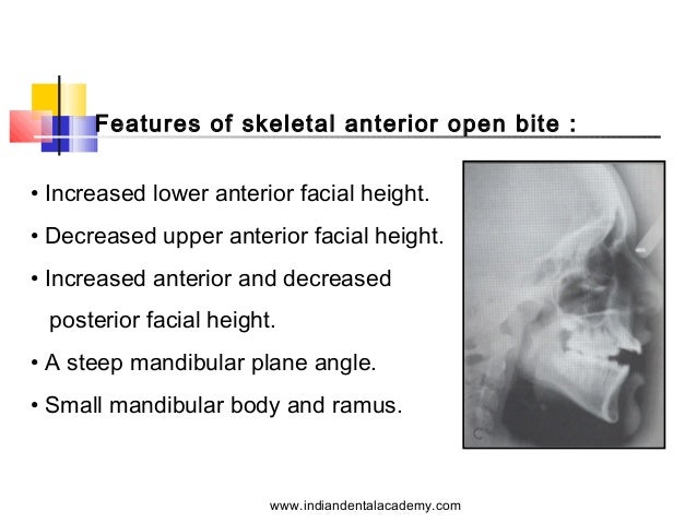 Open bite 1 /certified fixed orthodontic courses by Indian dental aca…