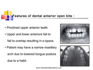 Open bite 1 | PPT