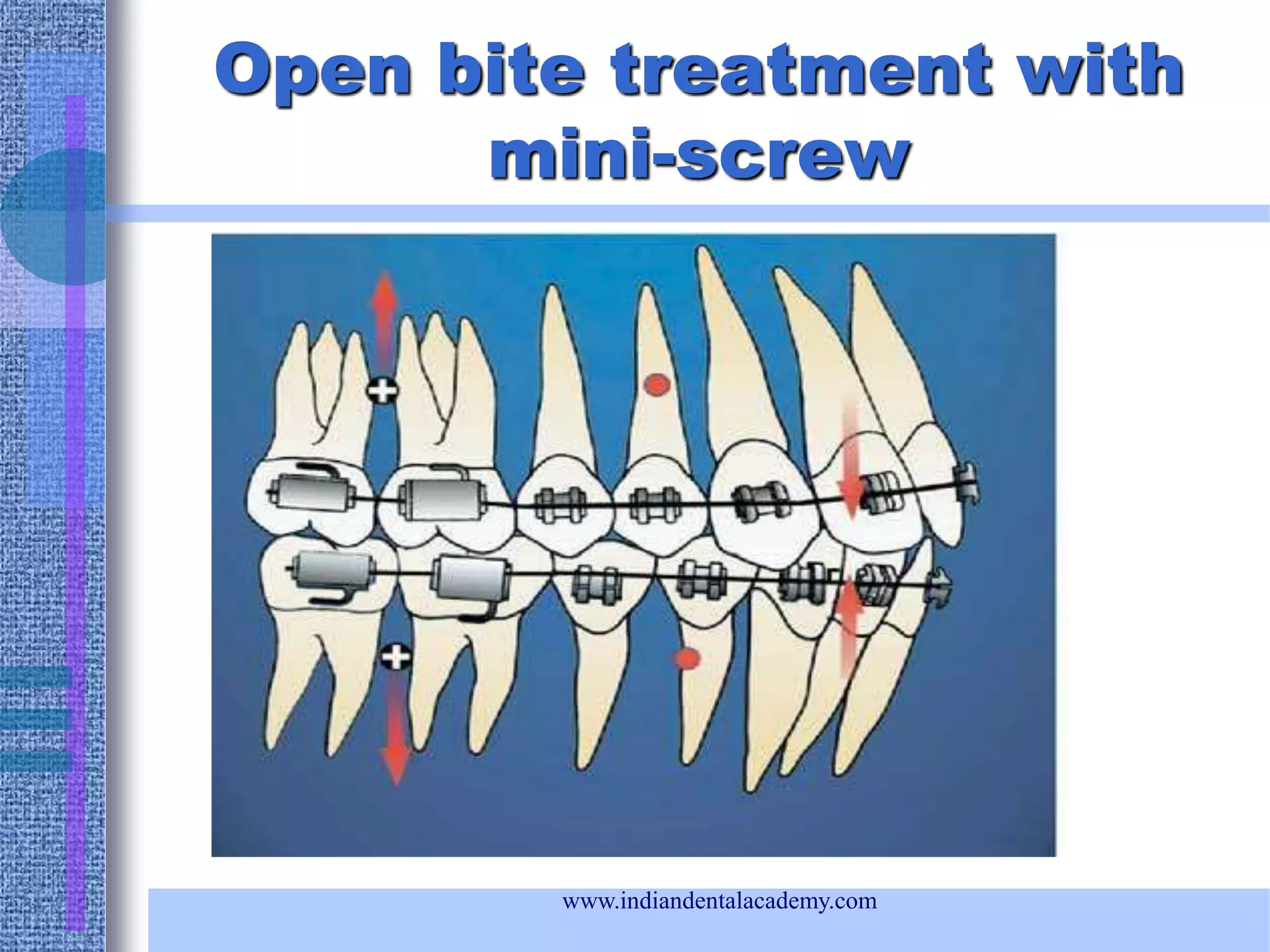 Management of open bite / oral surgery courses | PPT
