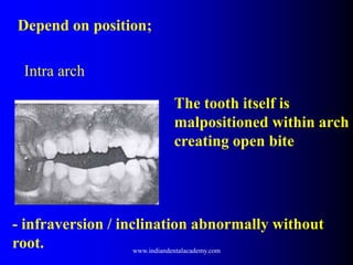 Open bite sem [recovered] /certified fixed orthodontic courses by ...