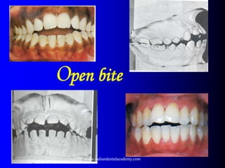 Open bite sem [recovered] /certified fixed orthodontic courses by ...