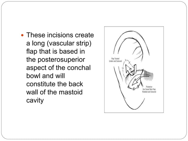 Open cavity mastoid operations | PPT