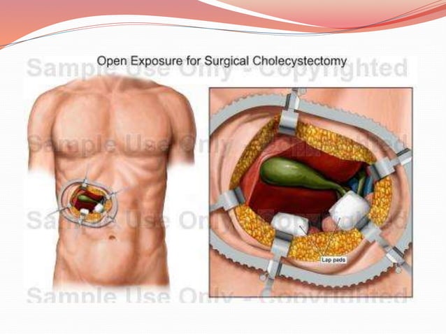 Open Vs Laparoscopic cholecystectomy | PPTX