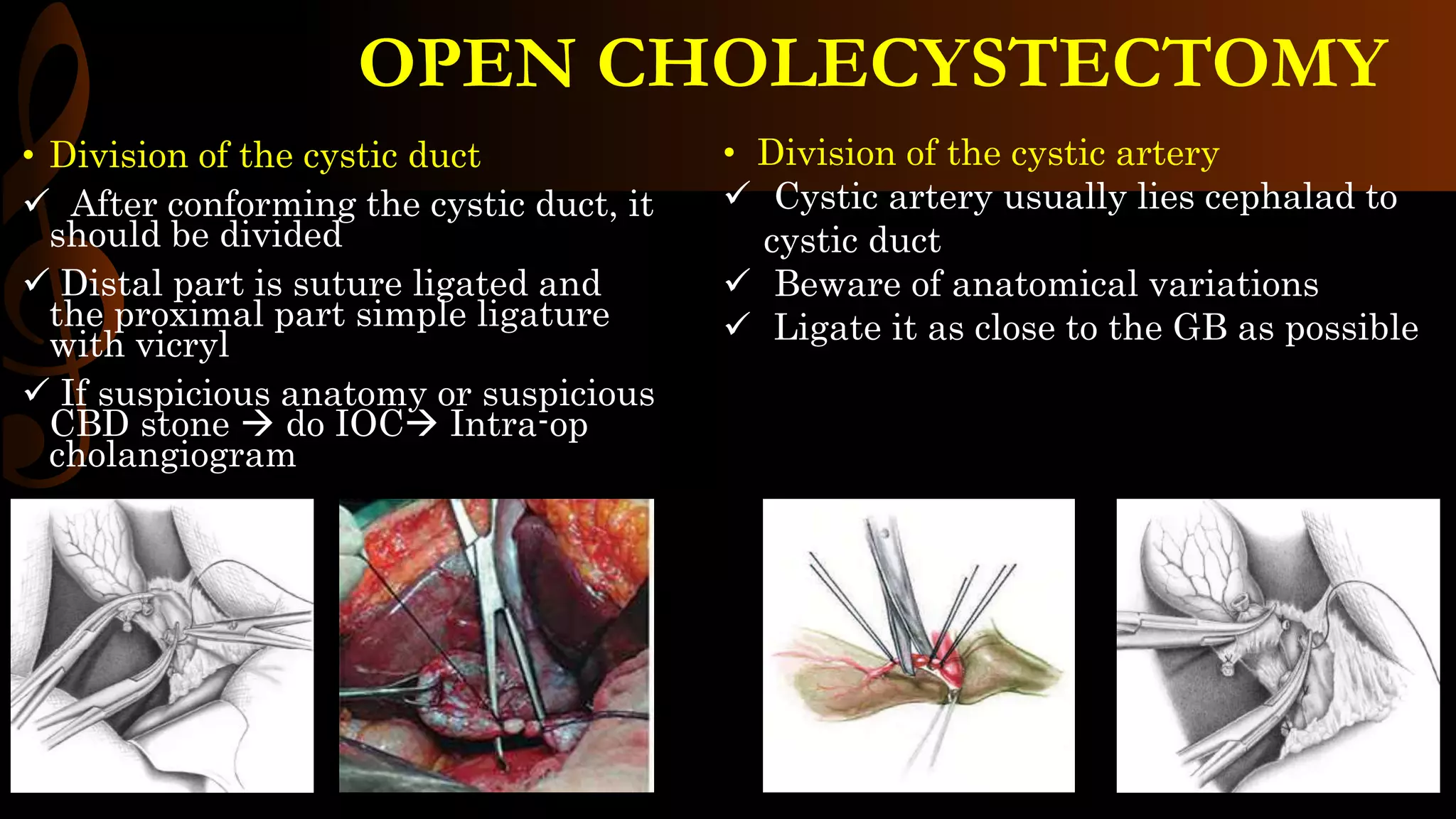 Open cholecystectomy/ operative surgery | PPTX