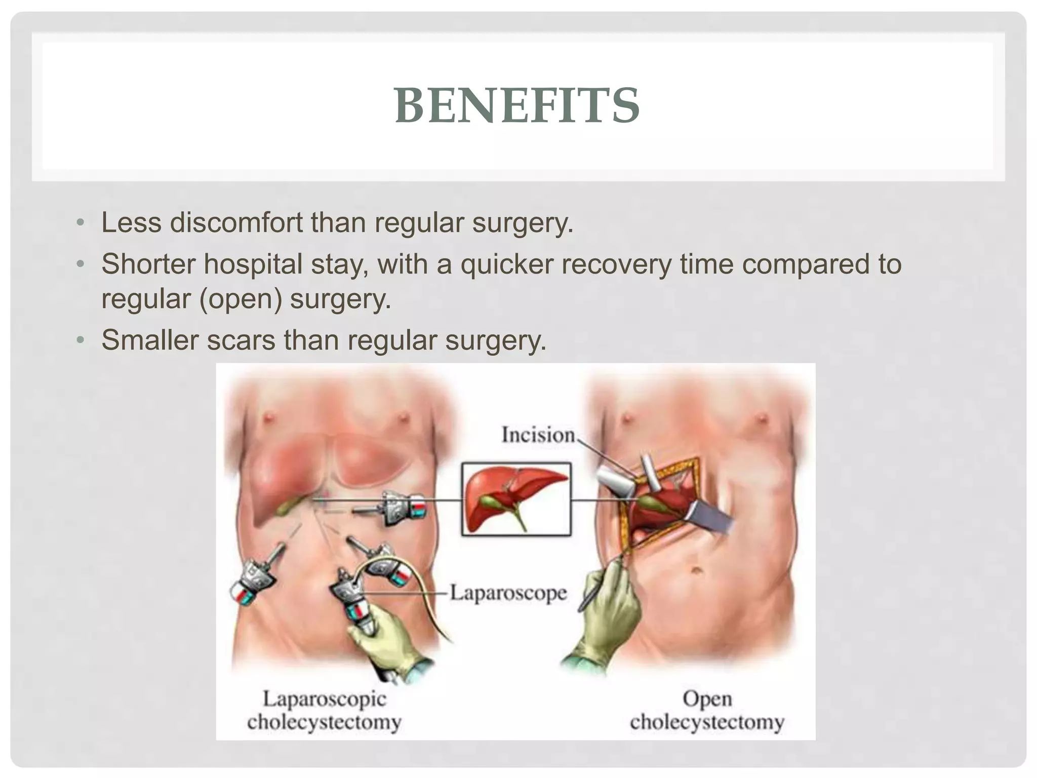 Open cholecystectomy vs laparoscopic cholecystectomy | PPTX | Digestive Disorders | Diseases and ...