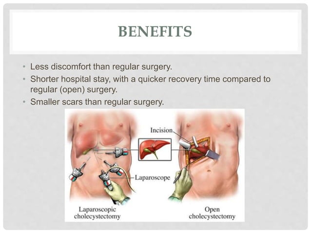 Open cholecystectomy vs laparoscopic cholecystectomy