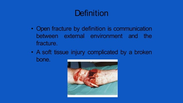 Open fracture management | PPTX