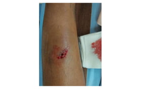 Open fracture | PPTX