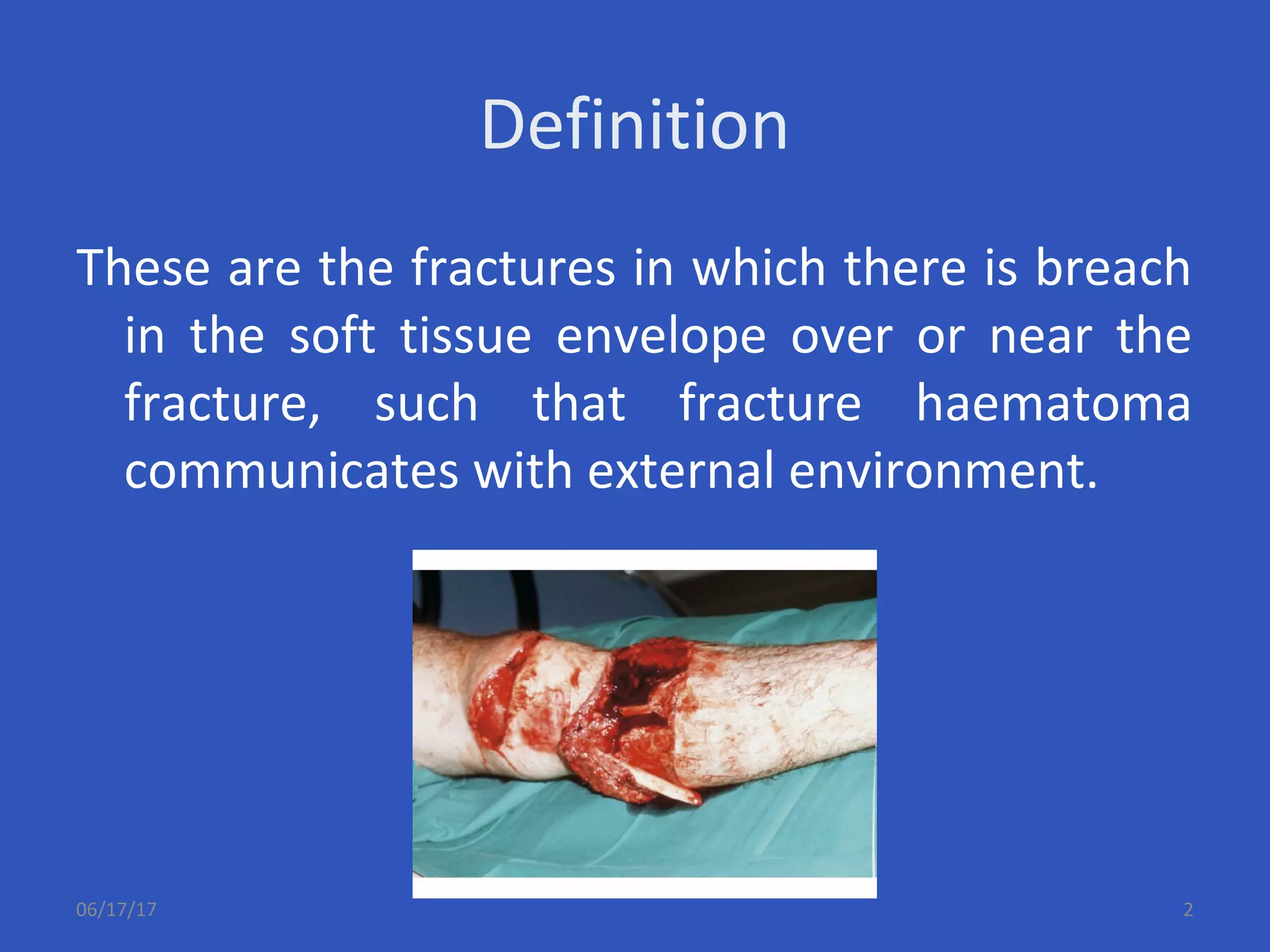 Openfracture | PPT