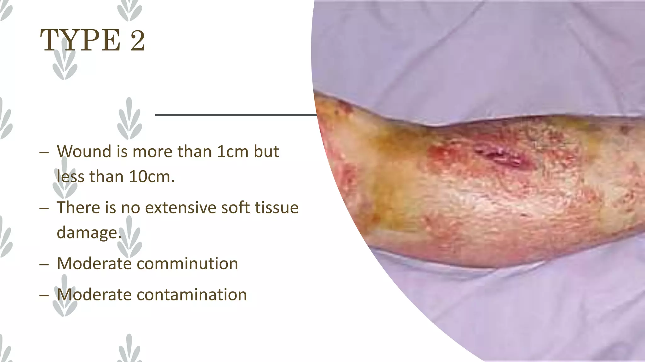Open fracture | PPTX