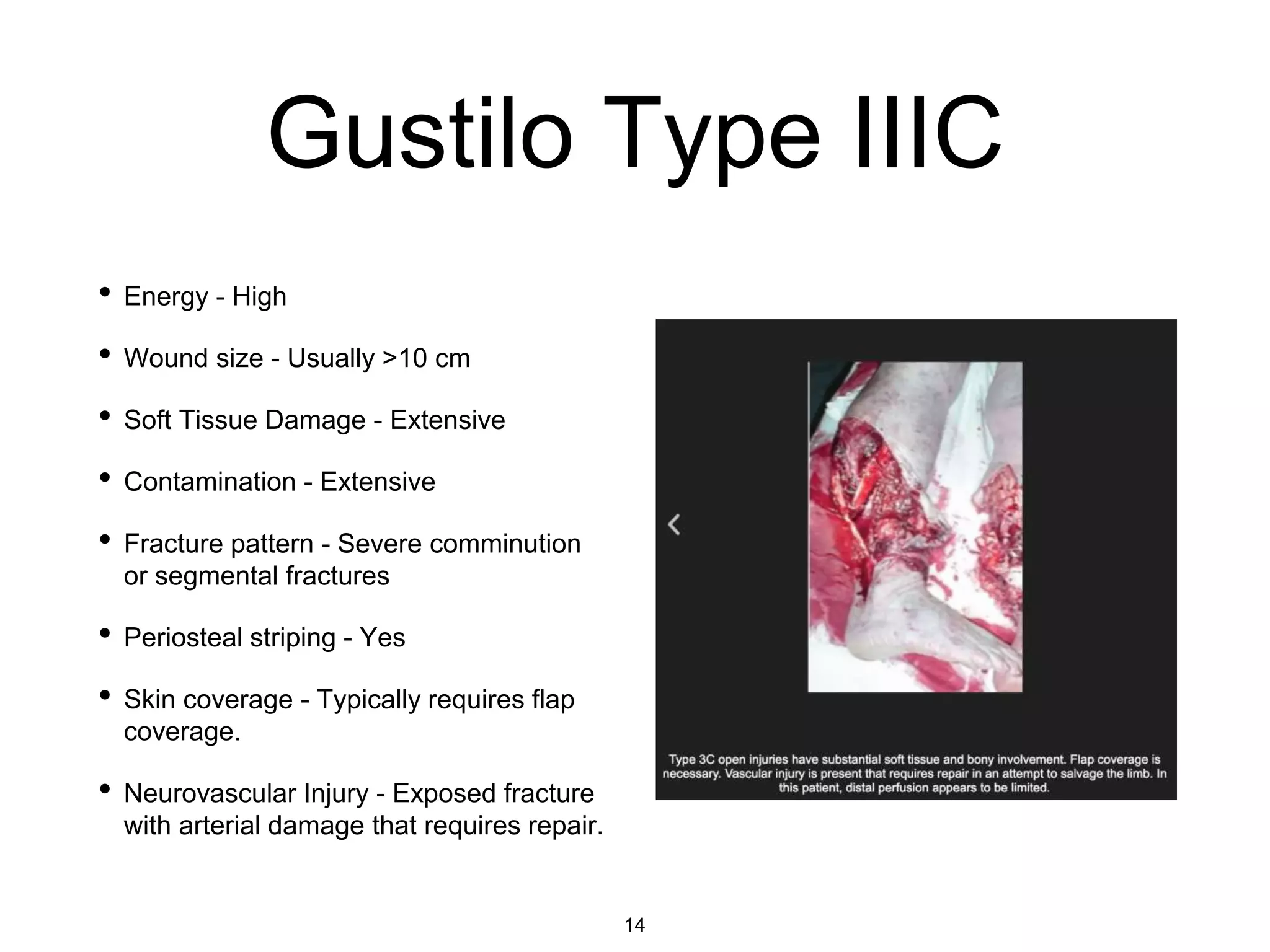 Open fracture | PPTX