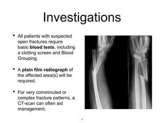 Open fracture | PPTX