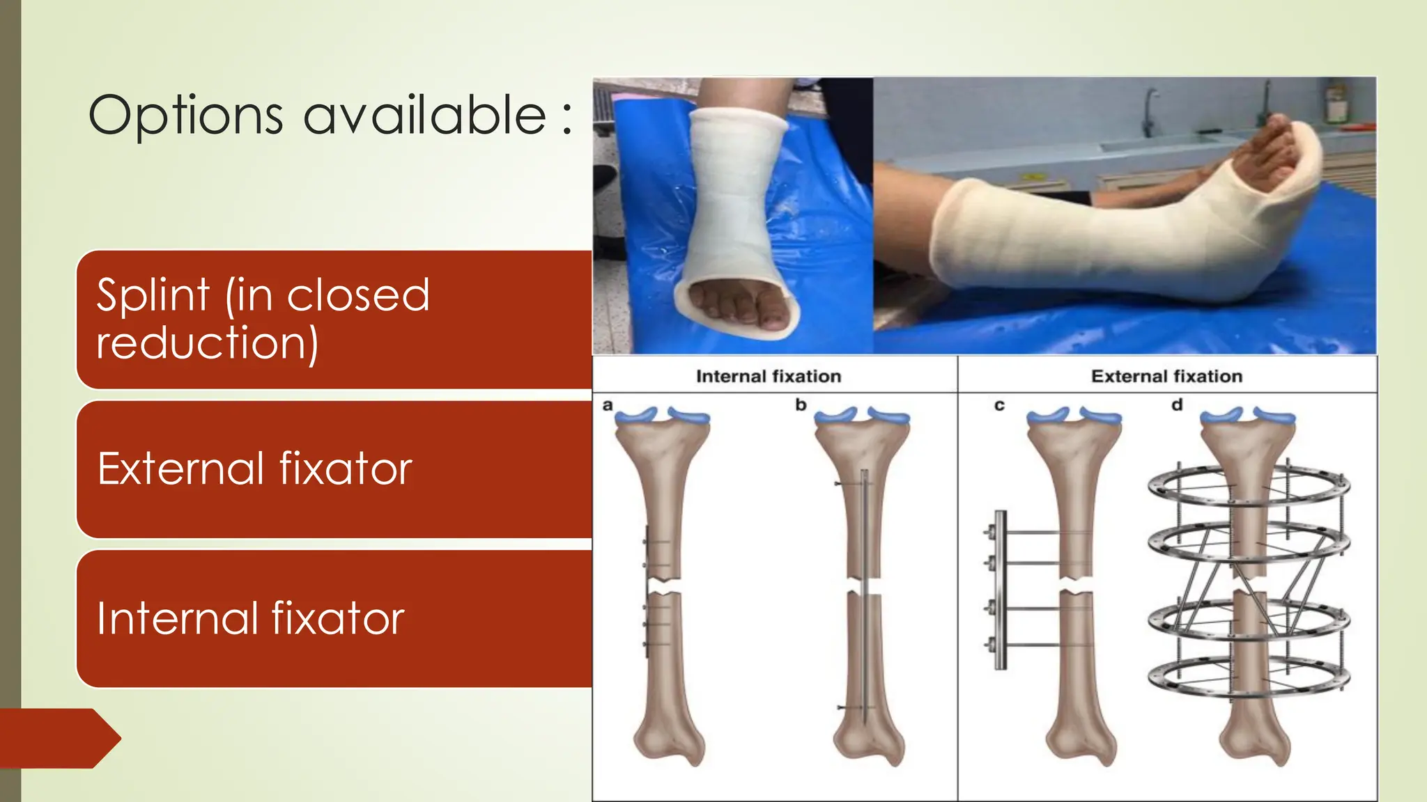 OPEN FRACTURE DEFINITION CLASSIFICATION MANAGEMENT.pdf