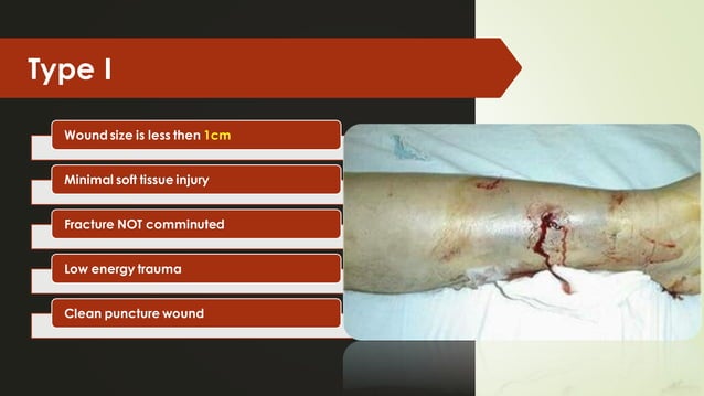 OPEN FRACTURE DEFINITION CLASSIFICATION MANAGEMENT.pdf