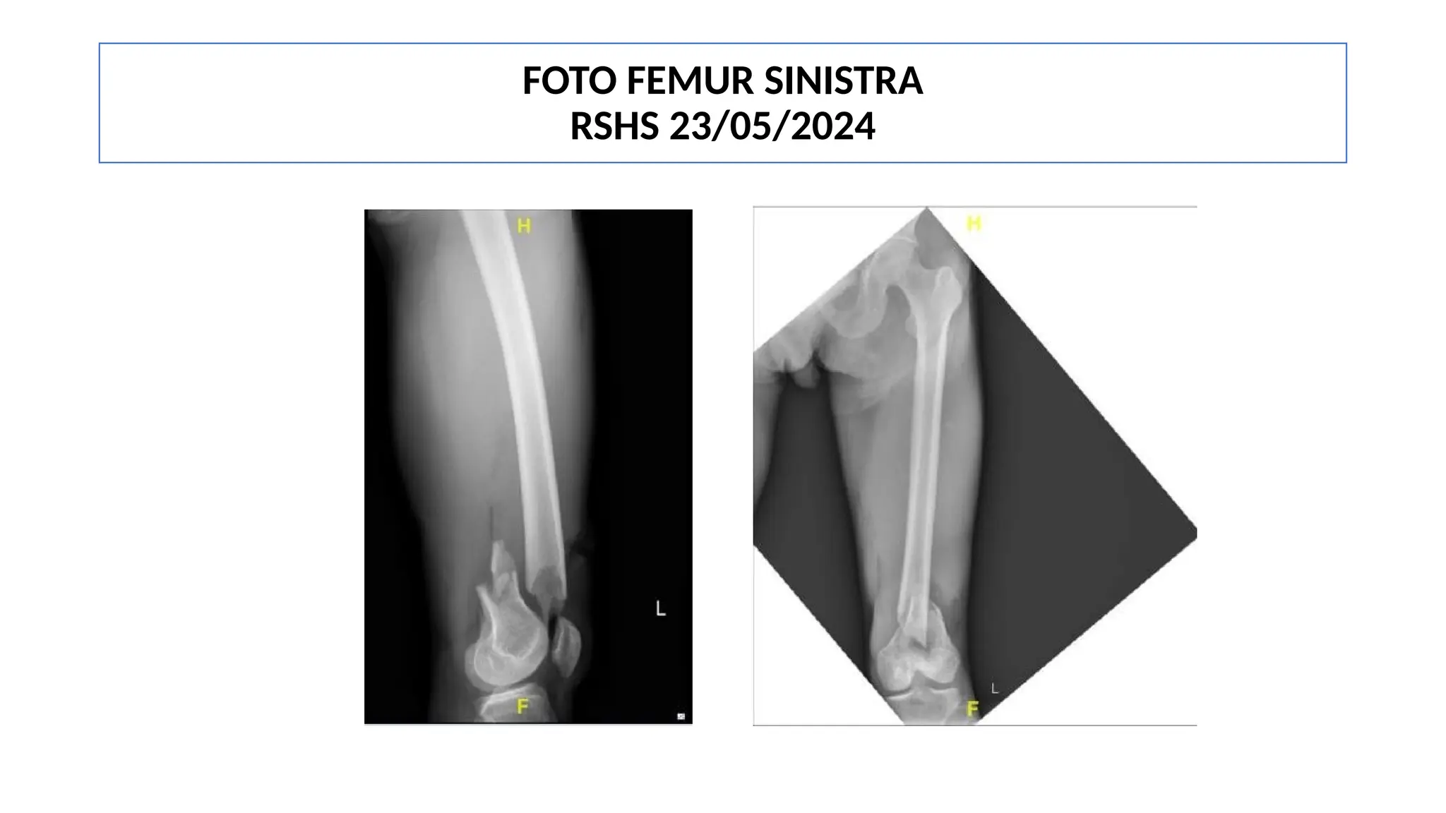 Open Fracture ar femur sinistra distal Tcherne Classification +Moderate ...