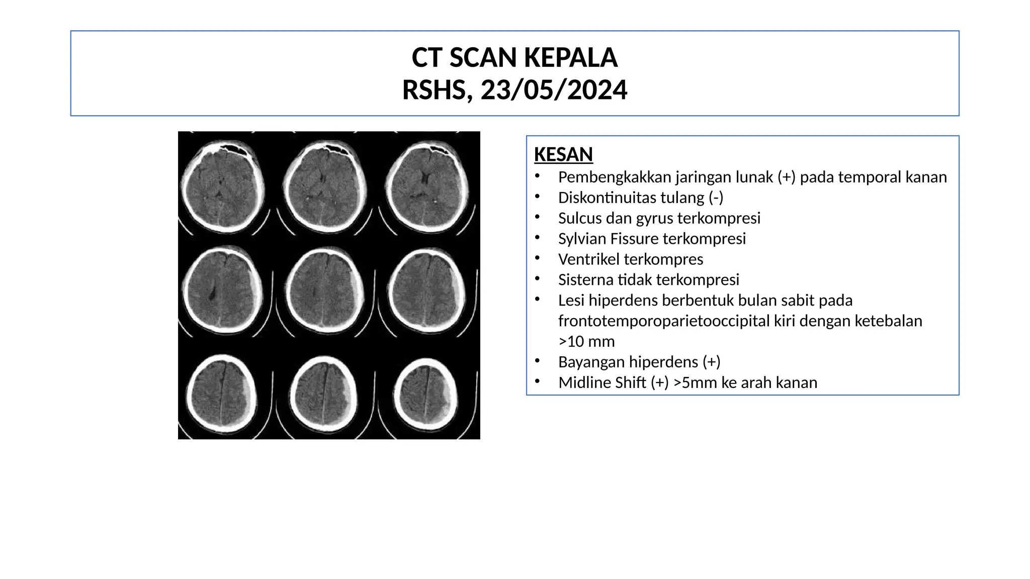 Open Fracture ar femur sinistra distal Tcherne Classification +Moderate ...