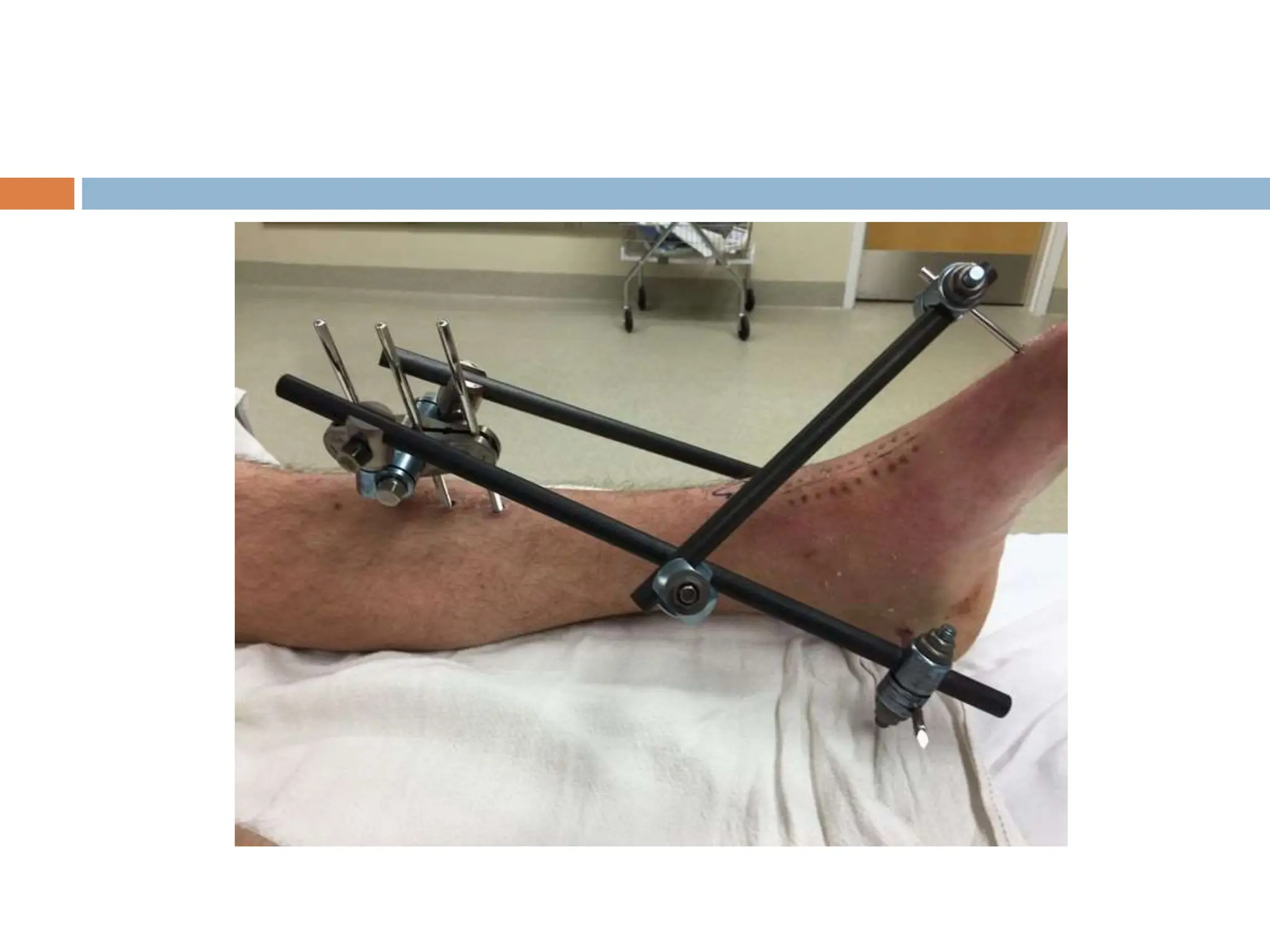 OPEN FRACTURE MANAGEMENT AND ITS COMPLICATIONS | PPT