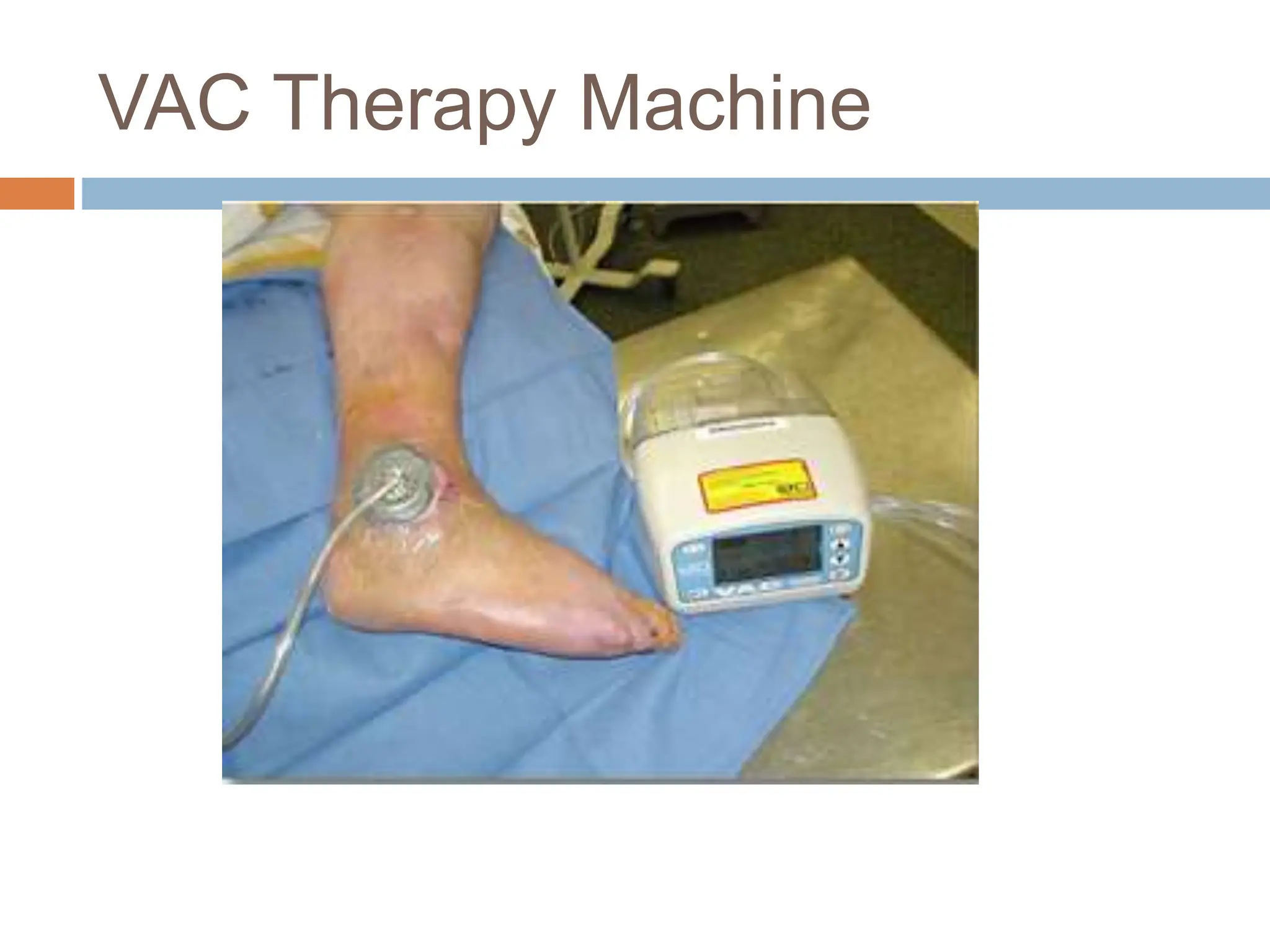 OPEN FRACTURE MANAGEMENT AND ITS COMPLICATIONS | PPT
