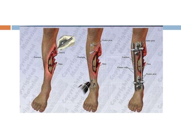 OPEN FRACTURE MANAGEMENT AND ITS COMPLICATIONS | PPT