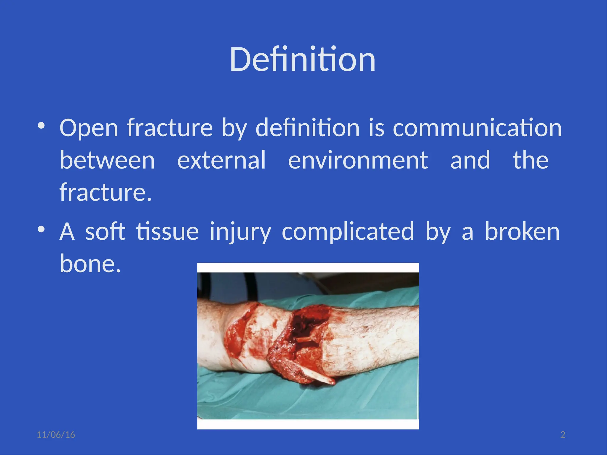 open fracture management.pptxrtgghjjhhyyyg | PPTX