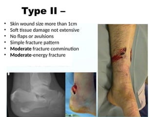 Open Fracture management 2-.........1.pptx