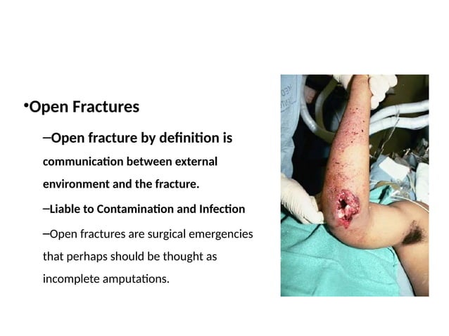 Open Fracture management 2-.........1.pptx