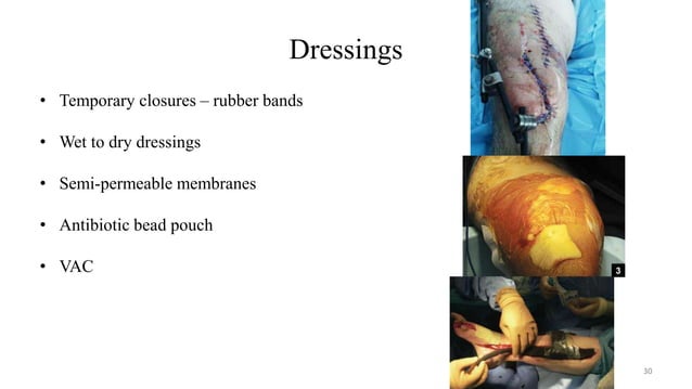 OPEN FRACTURE MANAGEMENT AND PRINCIPLE OF EXTERNAL FIXATION.pptx