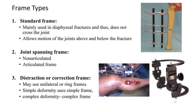 OPEN FRACTURE MANAGEMENT AND PRINCIPLE OF EXTERNAL FIXATION.pptx