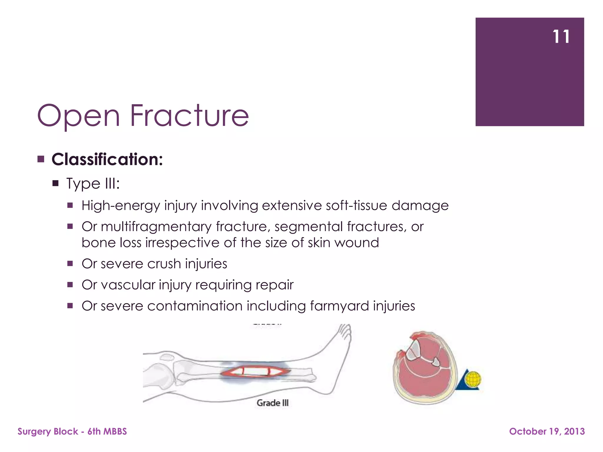 Open Fractures | PPTX