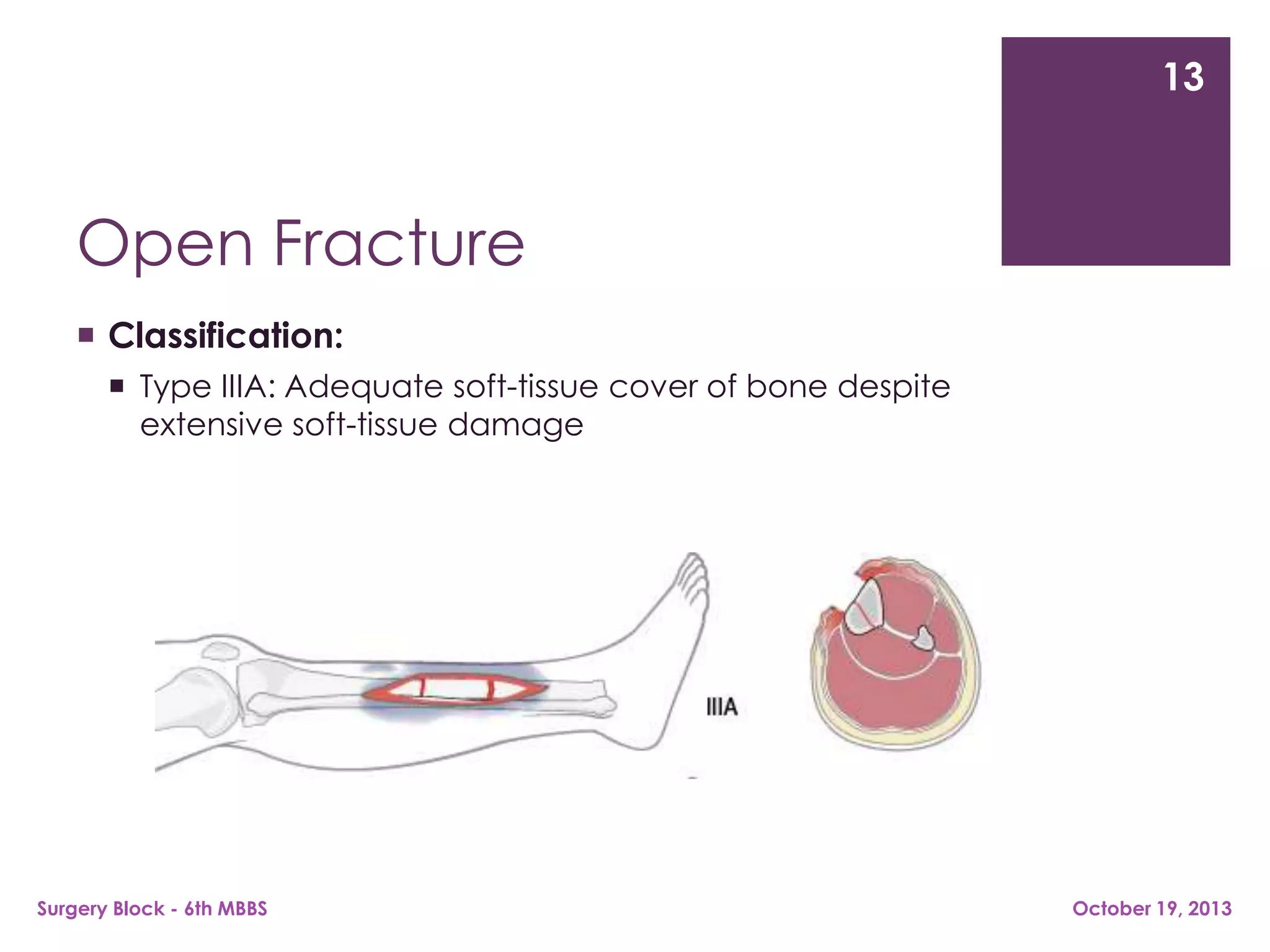 Open Fractures | PPTX