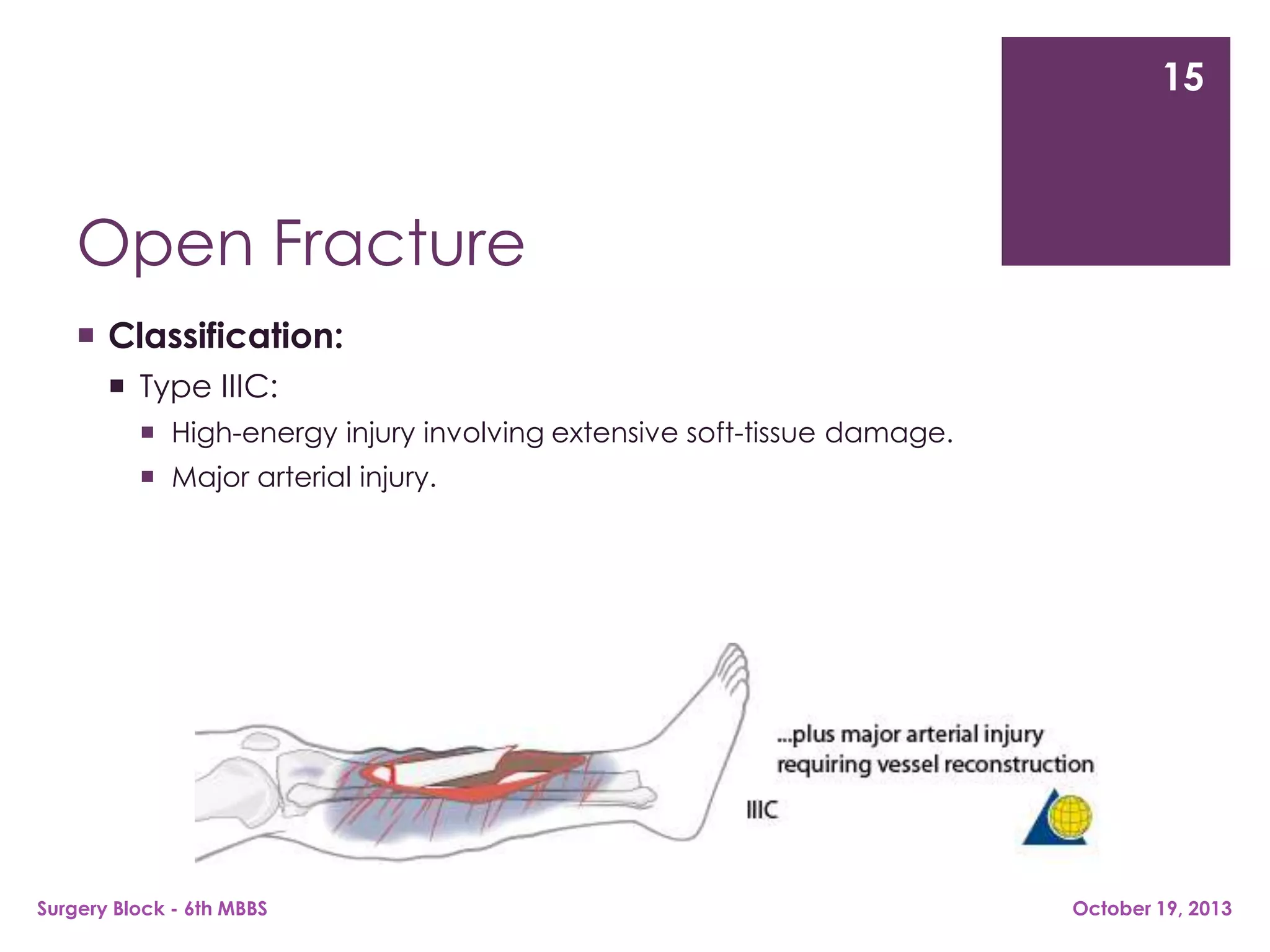 Open Fractures | PPTX