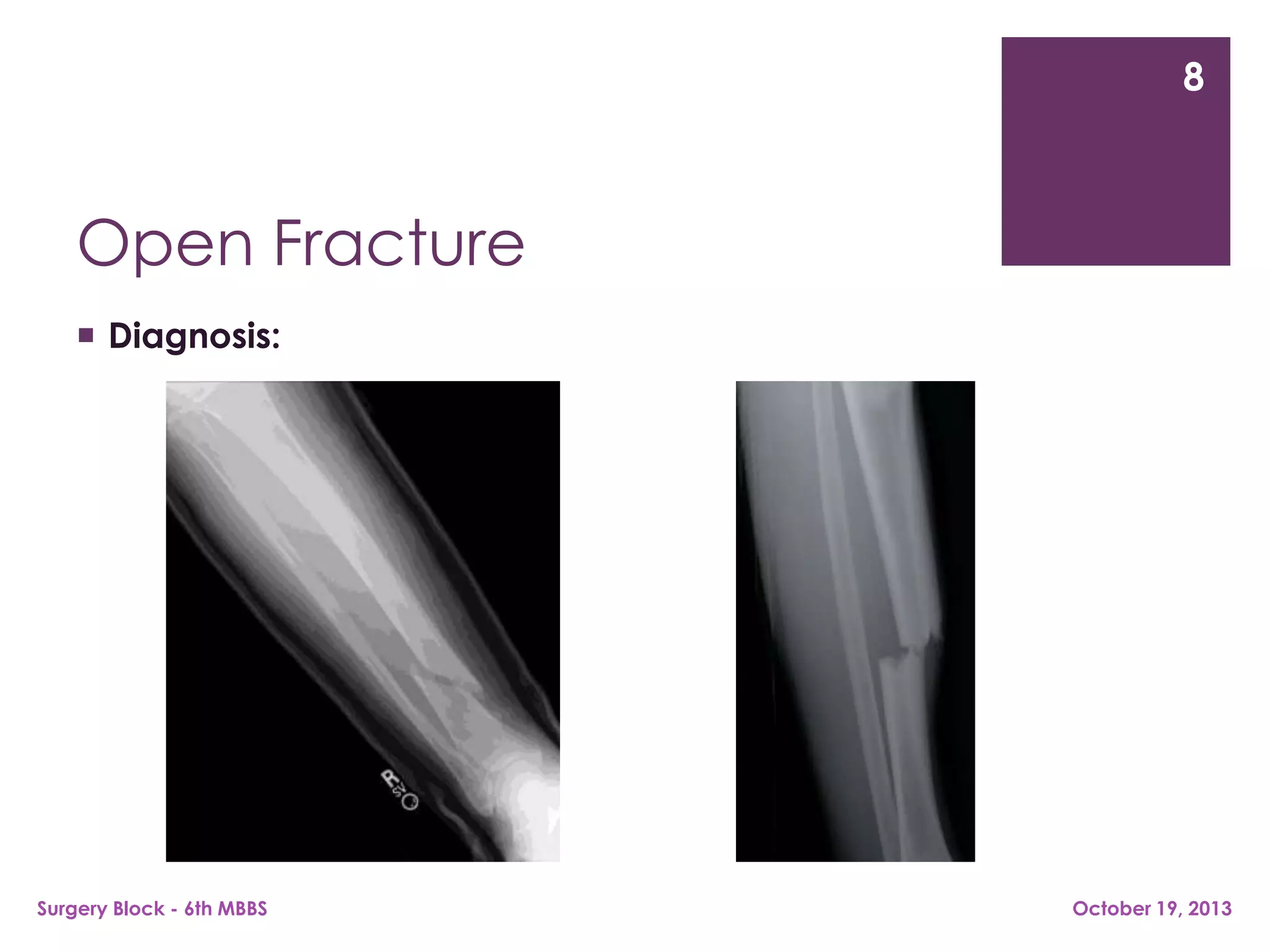 Open Fractures | PPTX